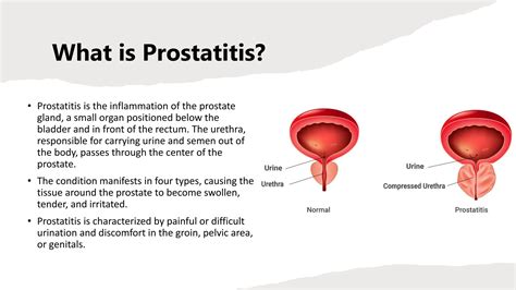 Prostatitis Explained Symptoms Causes And Treatment Guide Pptx
