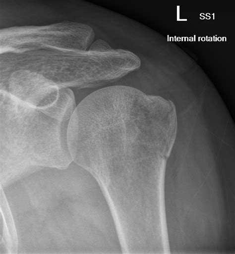 Left Shoulder X Ray Fracture At Jeremy Sanchez Blog