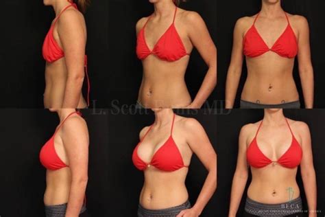 Best Plastic Surgery Before And After Breast Inspiring Your Life