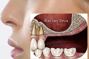 Quick Guide To Sinus Lift Surgery