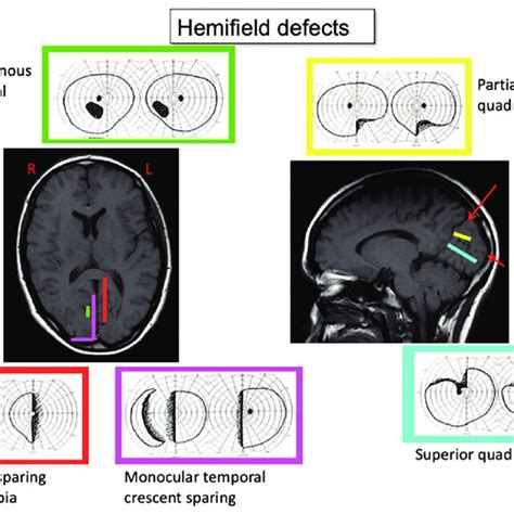 Hemifield Defects From Lesions Of Striate Cortex Defects Are Highly Download Scientific
