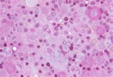 Sideropenic Syndrome With Iron Deficiency Anemia Symptoms Treatment