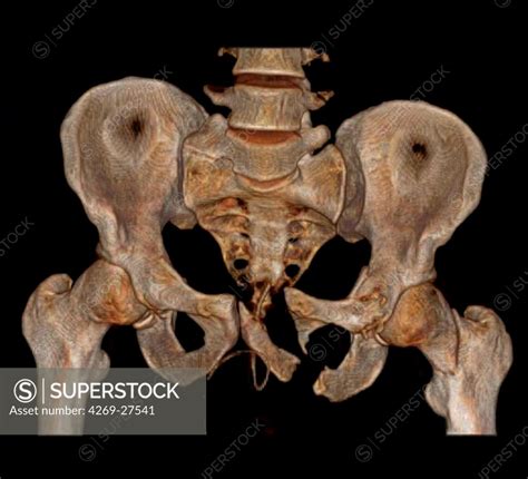Fractured Pelvis 3d Computed Tomographic Ct Reconstruction Scan Of