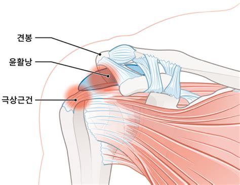 어깨충돌증후군 서재곤링커병원