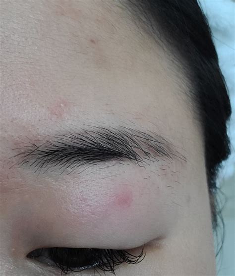 눈 여드름 뾰루지 지식in