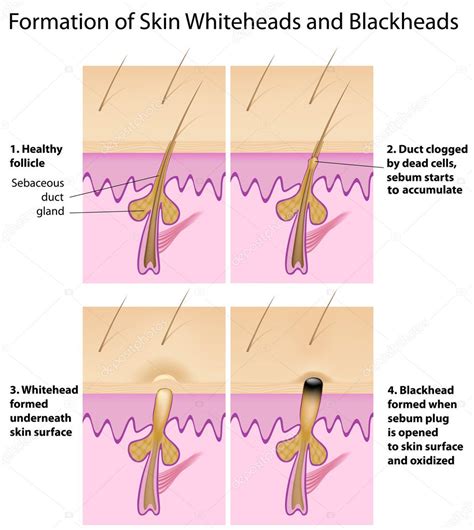 Best Ways To Get Rid Of Blackheads Health