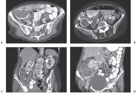 111 Porcelain Appendix Secondary To An Appendiceal Mucocele Radiology Key