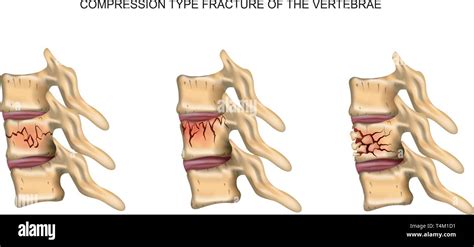 Compression Fracture Compression Fracture