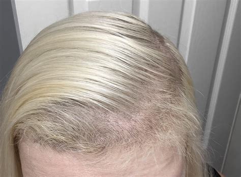 Side Swept Fringe Bangs Rtrichotillomania