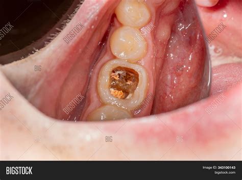 Dental Caries Molar