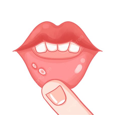 Mouth Ulcer Oral Problems Oral Health Oral Cavity Png Transparent