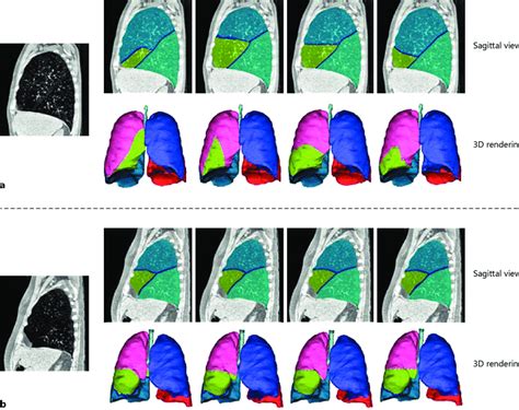 The Sagittal View And 3d Rendering Of The Sample Segmentation Of The Ct
