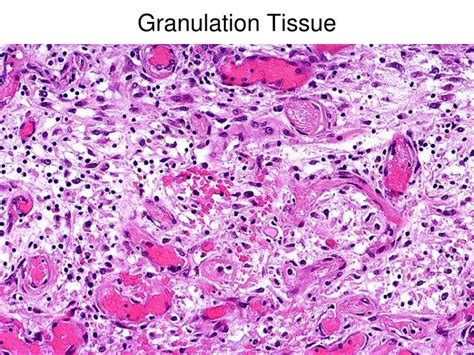 Ppt Inflammation And Repair Powerpoint Presentation Id 1993668