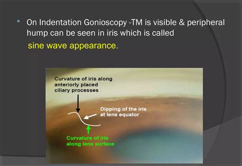 Gonioscopy Ppt