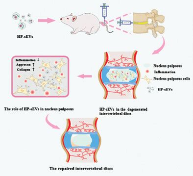 Hypoxic Preconditional Engineering Small Extracellular Vesicles Promoted Intervertebral Disc