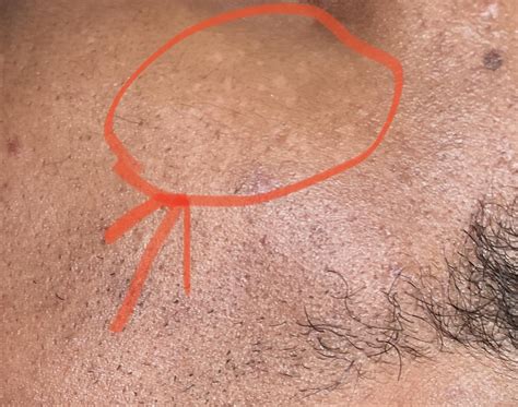 29m Hypopigmentation Spots On Face Etc Rskincareaddicts