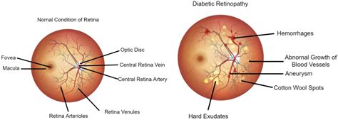 Diagnostics Free Full Text A Survey On Deep Learning Based Diabetic Retinopathy Classification