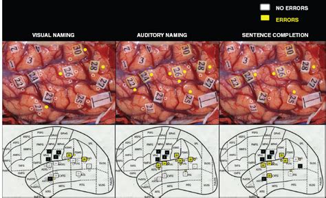 Brain Mapping And Monitoring Neupsy Key