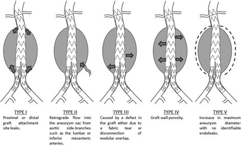 Endoleak Classification System³⁷ Download Scientific Diagram