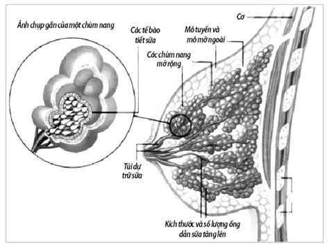 Cách Phát Hiện U Vú Lành Tính ác Tính