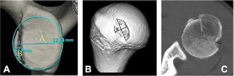 Quantification Method For Glenoid Defect Size And Hill Sachs Lesion