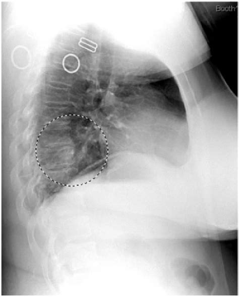 Chest Radiograph Showing Ill Defined Opacity Suspicious For Acute Chest Download Scientific