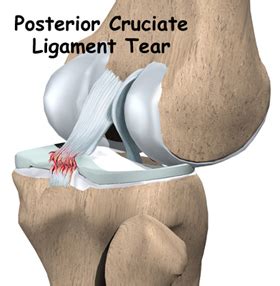Best Pcl Reconstruction Surgeon In Delhi Dr Biren Nadkarni
