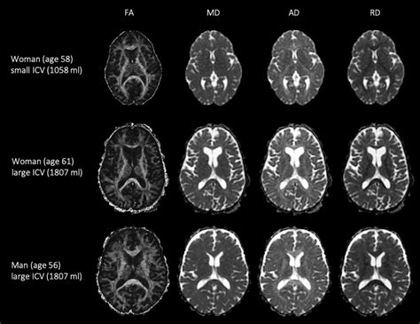 fractional anisotropy fa mean diffusivity md axial diffusivity