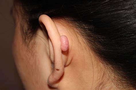 Ear Keloids Treatment Case Studies By Keloid Expert Dr Tirgan