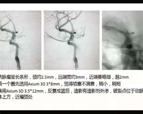 介入云课堂赵沃华教授脑动脉瘤介入栓塞术中破裂的原因及对策 脑医汇 神外资讯 神介资讯
