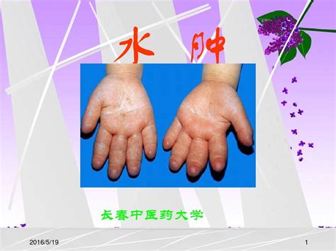 水肿 word文档在线阅读与下载 免费文档