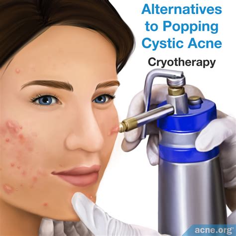 Cystic Acne Pop