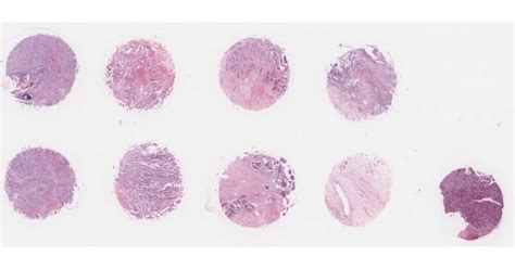 Br082c Breast Cancer Tissue Array Including Pathology Grade Tnm