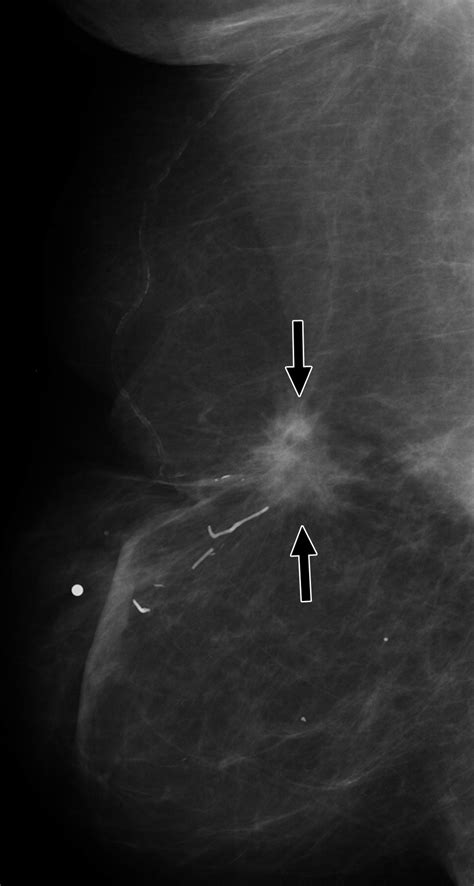 Breast Lift Fat Necrosis At Kristy Breeden Blog