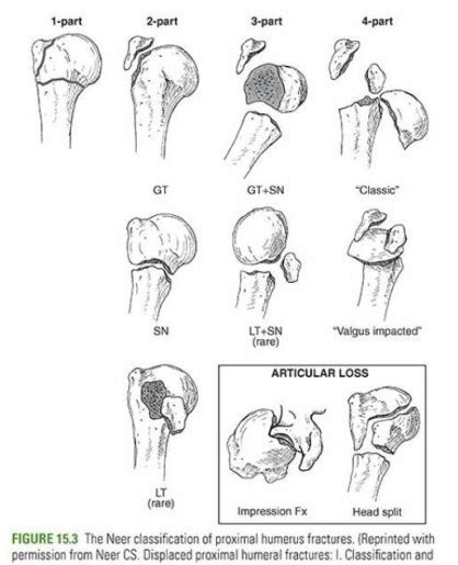 Neer Proximal Humerus Fracture Classification Rayorthos