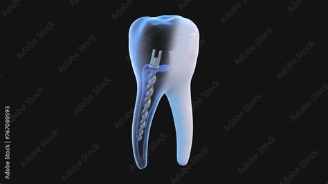 Dental Steel Post Inside Molar Teeth Xray View Dental Endodontic