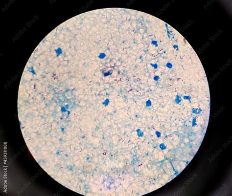 Pulmonary Tuberculosis Tb Sputum Afb Stain Microscopic Image To Diagnosis Mycobacterium