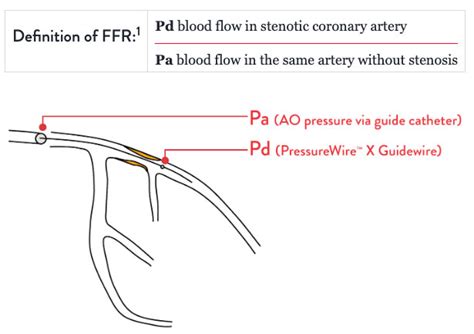 Epicardial Assessment With Ffr And Rfr Abbott