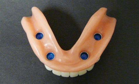 Dental Implant Supported Dentures Sure Fit Denture Clinic