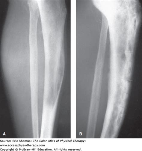 Pagets Disease Hepatic Metastasis From Perianal Pagets Disease