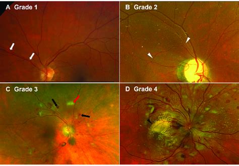 Stages Of Hypertensive Eye Disease The Scheie Classification Was Used