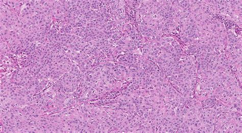 Squamous Cell Carcinoma Lung Histology Squamous Cell Carcinoma Of The