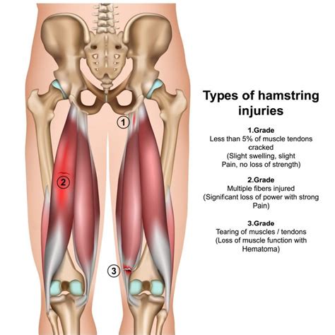 ACL Reconstruction Graft Choices Colorado Sports Medicine Orthopaedics Orthopaedics