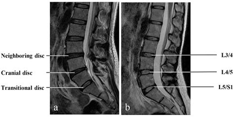 Osteophytes Lumbar