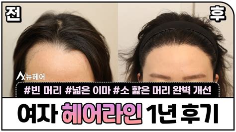 헤어라인교정후기 1년 후 넓은이마는 안녕ㅣ1200모낭 ~ 2000모낭ㅣ뉴헤어 Youtube