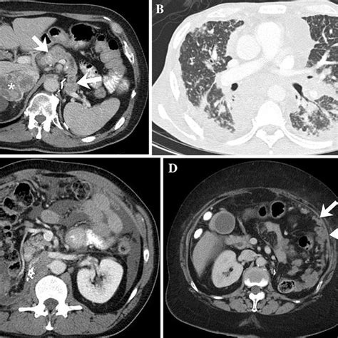 Impact Of Histologic Subtype And Sarcomatoid Transformation On