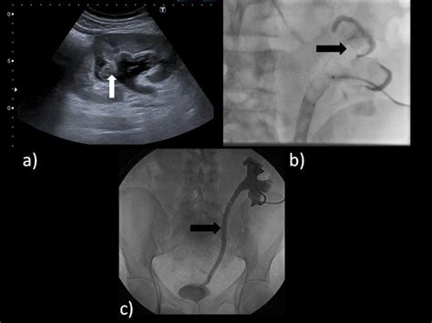 A Pyelocaliceal Dilation Due To Haematuria White Arrow Secondary To