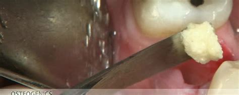 Socket Preservation After A Lower Molar Extraction Using An Allograft And A D Ptfe Membrane