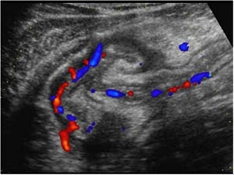 Abdomen And Retroperitoneum 16 Gastrointestinal Tract Case 168