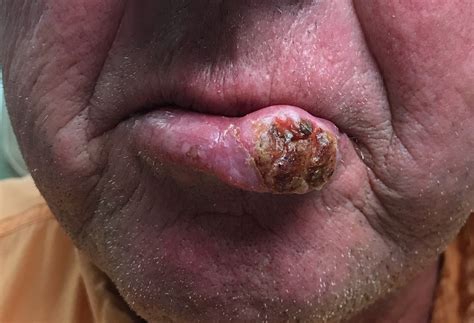 He Needs More Than Lip Service For This Lesion Mdedge